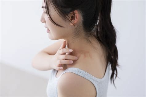 蕁麻疹（じんましん）とは？原因と治し方、身に覚えのないミミズ腫れを写真で解説 ヨクミテ｜医師監修の医療メディア