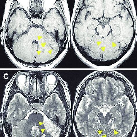 A Preoperative Computed Tomography Ct Scan Showing A Low Density