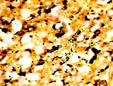 pathology outlines cat scratch disease