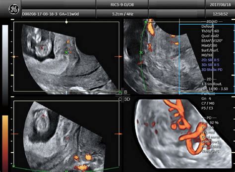Three Dimensional Power Doppler Reconstruction Of The Uterine Artery At