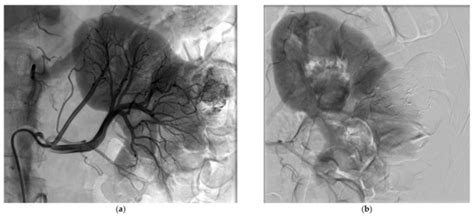 Jcm Free Full Text Selective Arterial Embolization With N Butyl