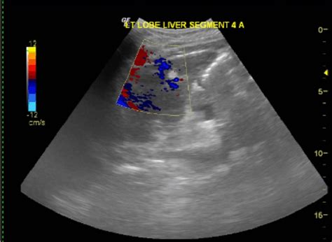 Color Flow Doppler Showing Hyperechoic Nodule In Left Lobe Of The Liver