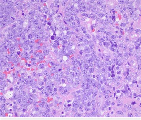 60x Magnification Pleomorphic Tumor Cells With Amphophilic Cytoplasm