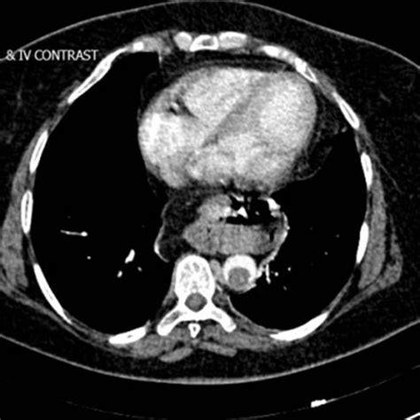 Abdominopelvic Ct Scan With Oral And Iv Contrast Axial View A