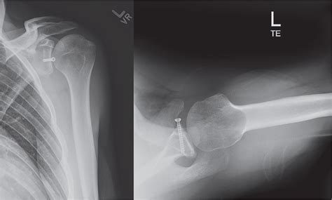 67 Arthroscopic Reduction And Internal Fixation Of Glenoid Rim