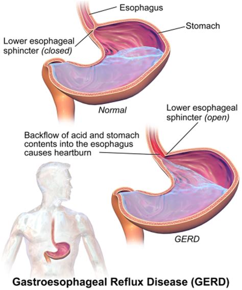 Gastroesophageal Reflux Disease Newport Cardiac And Thoracic Surgery