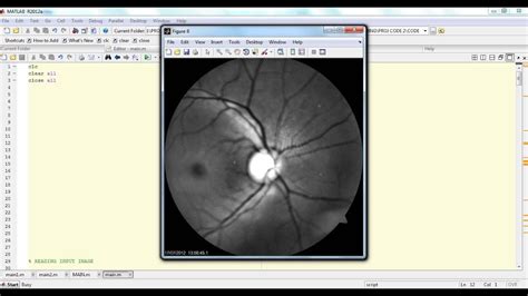 glaucoma detection using artificial neural networks