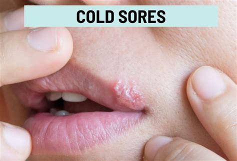 Cold Sore Vs Pimple Pictures And Differences