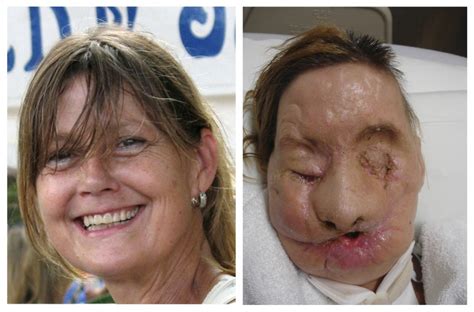 Charla Nash Wins 4m After Chimpanzee Ripped Her Face Off