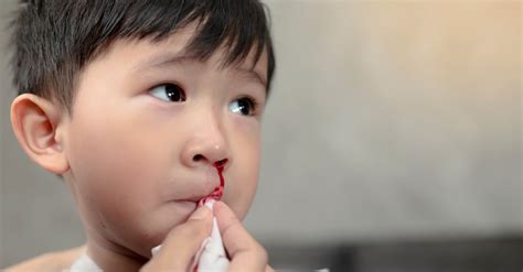 Hướng Dẫn Cách Xử Lý Khi Trẻ Bị Chảy Máu Cam