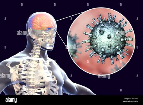 Encephalitis Caused By Varicella Zoster Virus Vzv Computer