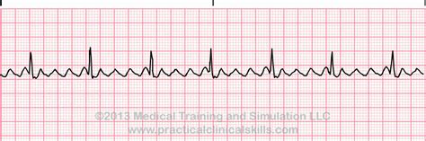 atrial dysrhythmias