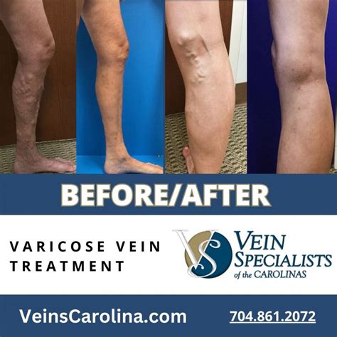 Reclaiming Confidence Before And After Vein Treatment Vein