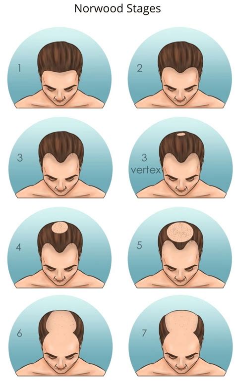 Hair Transplant For Receding Hairline Heva Clinic