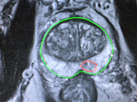 Prostate Mri And New Biopsy Techniques Endeurology