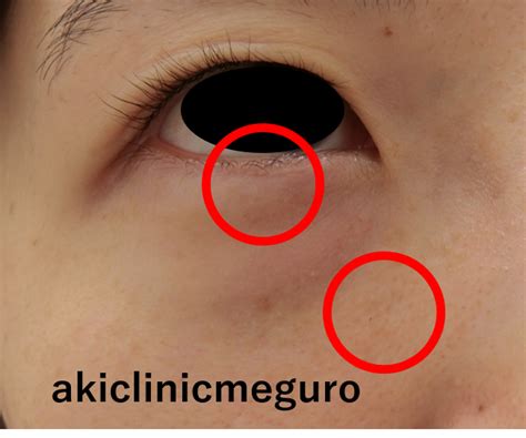 目の下・頬にできた稗粒腫（白ニキビ）が気になる方へ｜目黒駅前アキクリニック