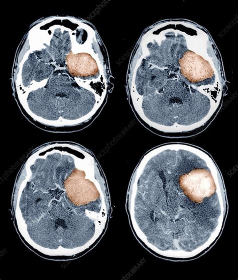Brain Tumour Ct Scans Stock Image C026 9956 Science Photo Library