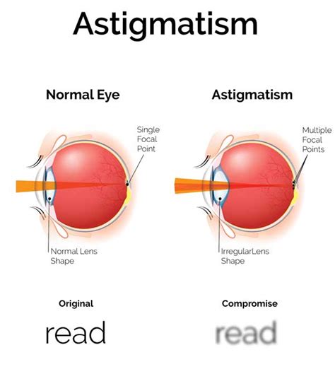 Astigmatism Causes Definition Types Treatment