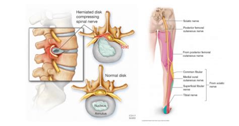 Radiculopathy Treatment Inline Physio