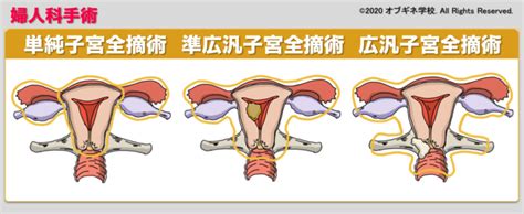 医学生のための婦人科癌手術の基本│見えてくる産婦人科学 オブギネ学校