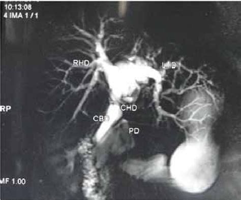 Magnetic Resonance Imaging Scan Of Intrahepatic Biliary Cystadenoma