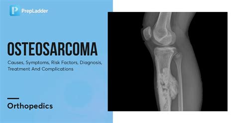 Osteosarcoma Causes Symptoms Risk Factors Diagnosis Treatment And