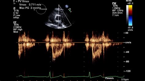 Normal Complete 2d Echocardiogram With Color Doppler And Spectral