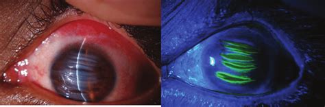 A Left New Horizontal Corneal Epithelial Defects B Right