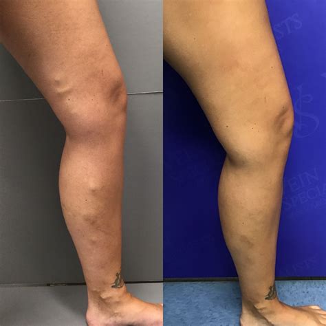 Before And After Vein Treatment Photos Vein Specialists Of The Carolinas
