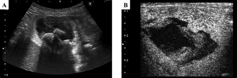 Contrast Enhanced Transabdominal Ultrasonography Revealed A
