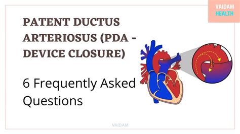 Patent Ductus Arteriosus 6 Frequently Asked Questions Youtube