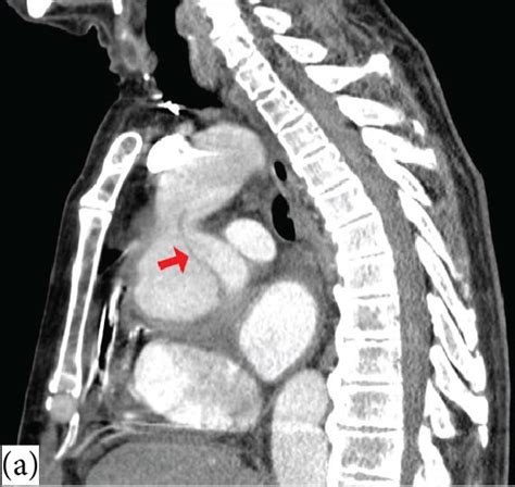 Ct Scan Of The Abdomen Showing Acute Ascending Thoracic Aortic Aneurysm