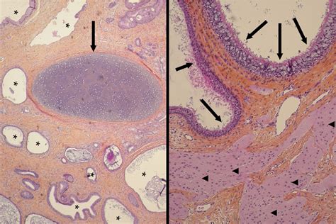 Figure 3 From Combined Endonasal And Neurosurgical Resection Of A