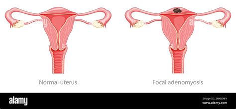 Focal Adenomyosis Human Anatomy Female Sick And Normal Reproductive