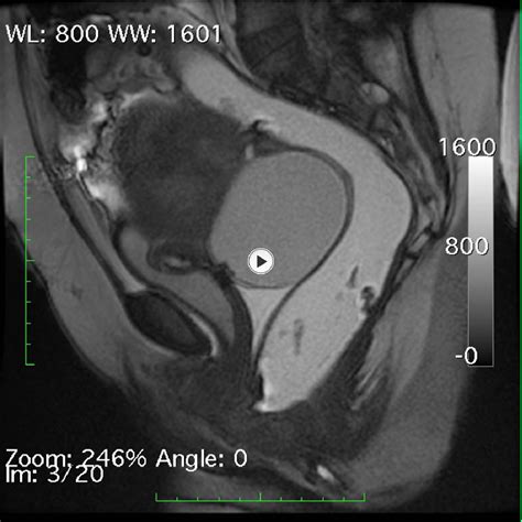 Mri Defecography Anatomic And Functional Cine Based Evaluation Of The