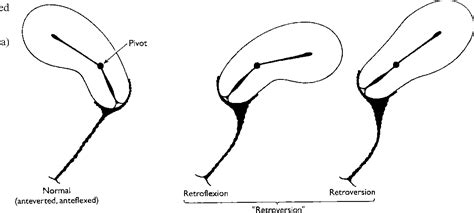 Retroverted Uterus