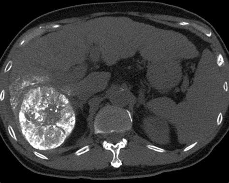 Liver Atlas Case 107 Transarterial Chemoembolization Tace Hcc