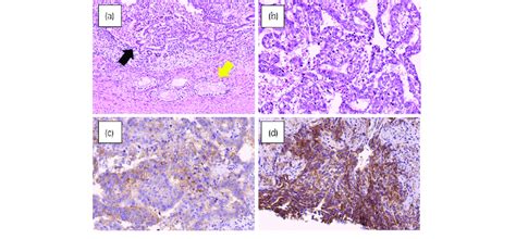 The Pathological Results Of The Right High Inguinal Orchiectomy A