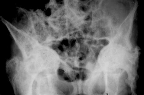 Ii2 Final Pagets Disease Xrays Flashcards Quizlet