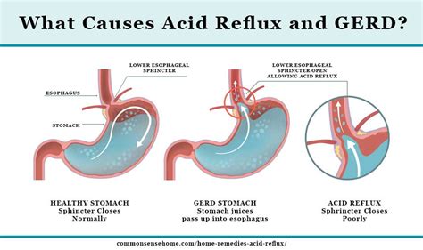 10 Home Remedies For Acid Reflux And The Problem With Ppis For Gerd