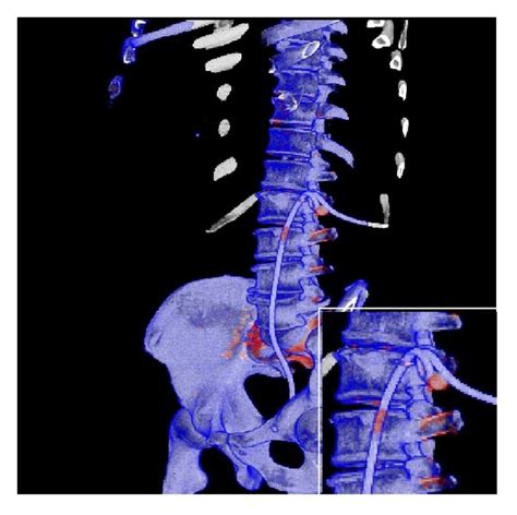 Three Dimensional Dual Energy Computed Tomography 3d Dect Images