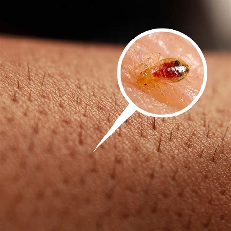 can you feel bed bugs crawling on your skin bed bug sos