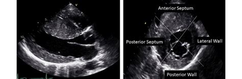 Parasternal Long Axis And Short Axis View Of An Hcm Patient With