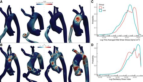 Patient Specific Computational Fluid Dynamics Reveal Localized Flow