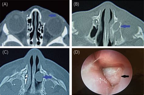Congenital Dacryocystocele A Left Cyst Located At The Lacrimal Sac