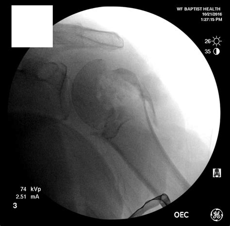 Shoulder And Elbow Surgery Proximal Humerus Fracture Dislocation How