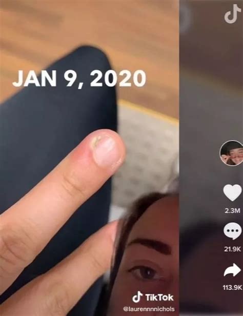 Teen Almost Lost Finger After Lifelong Nail Biting Habit Led To Horror