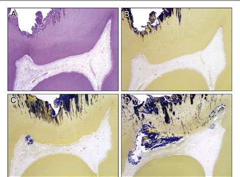Figure 1 From Correlation Between Clinical And Histologic Pulp