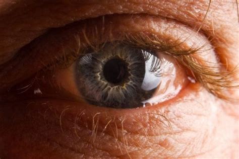 How To Treat Epiphora Watering Eyes The Best Of Health