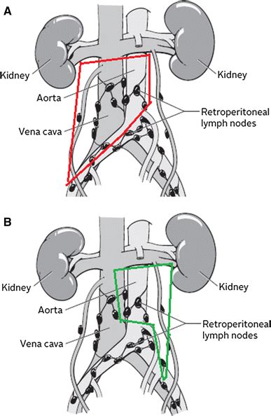 Unilateral Modified Retroperitoneal Lymph Node Dissection Right